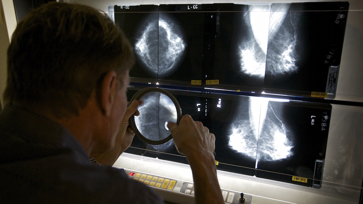 Can a mammogram help identify heart disease? – NBC 7 San Diego