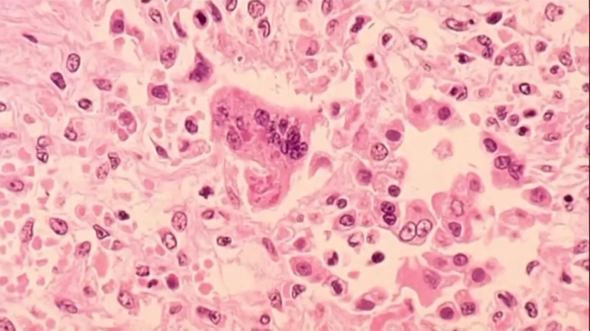 San Diego County’s first measles case since 2019 confirmed – NBC 7 San ...