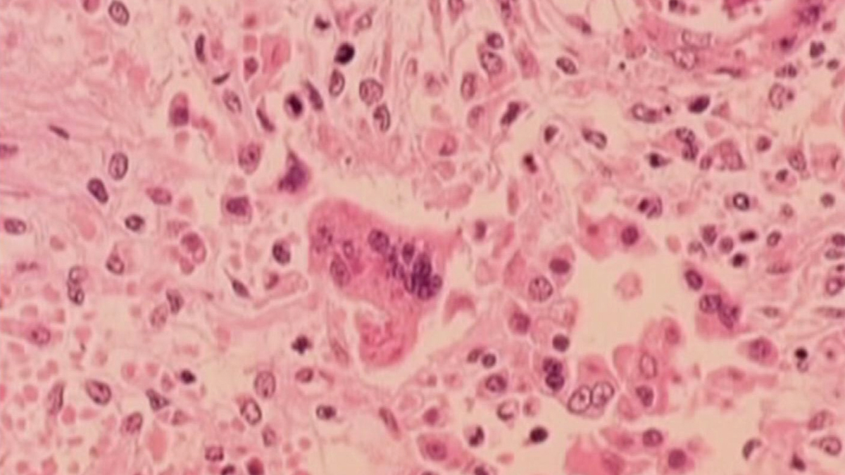 CDC issues alert over rising measles cases in US; 1 case reported in ...