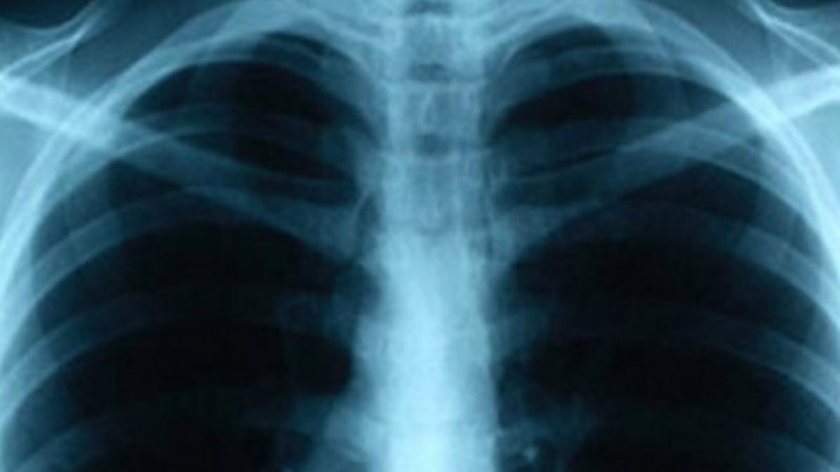 MTS Blue Line may have been exposed to tuberculosis – NBC 7 San Diego