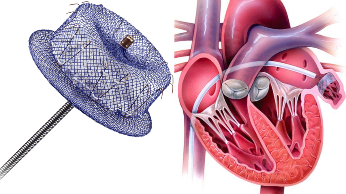 Sharp Memorial Hospital Makes History, Implants Anti-Stroke Device in ...