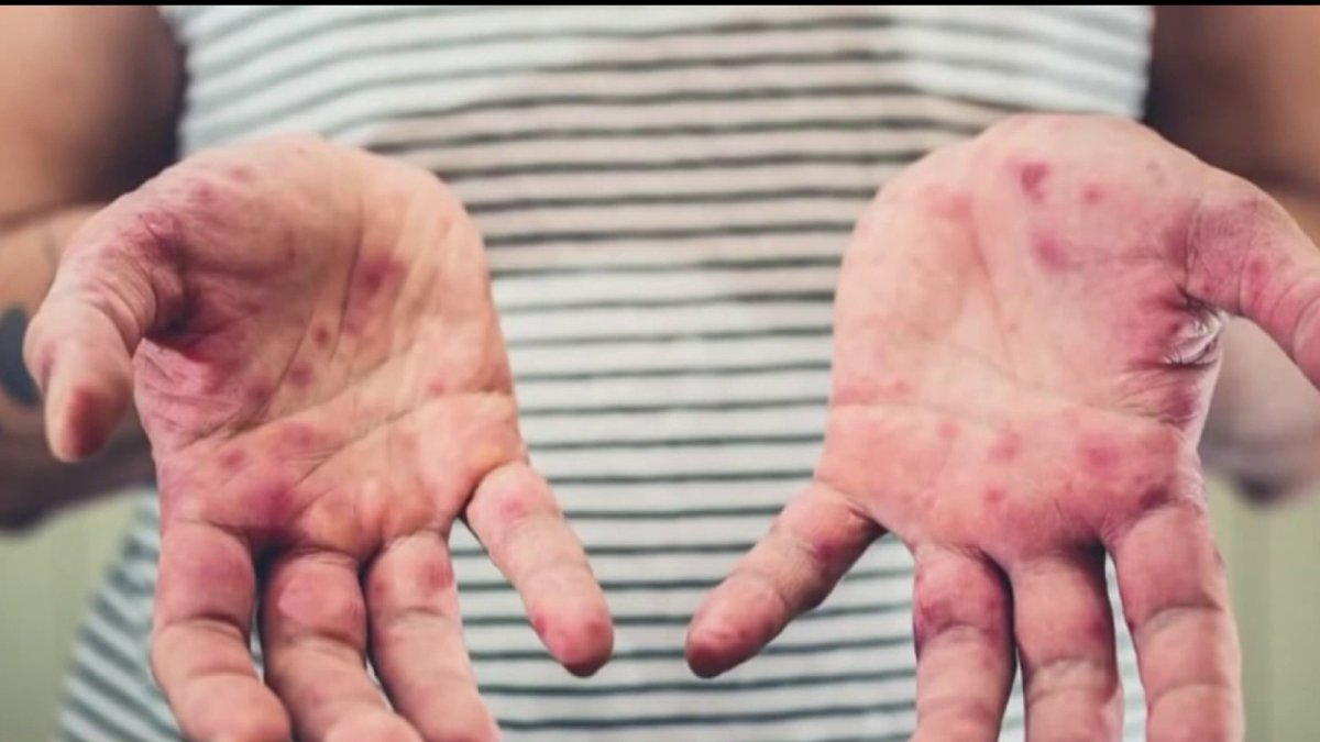 CDC issues alert over rising measles cases in US and 1 case in San ...