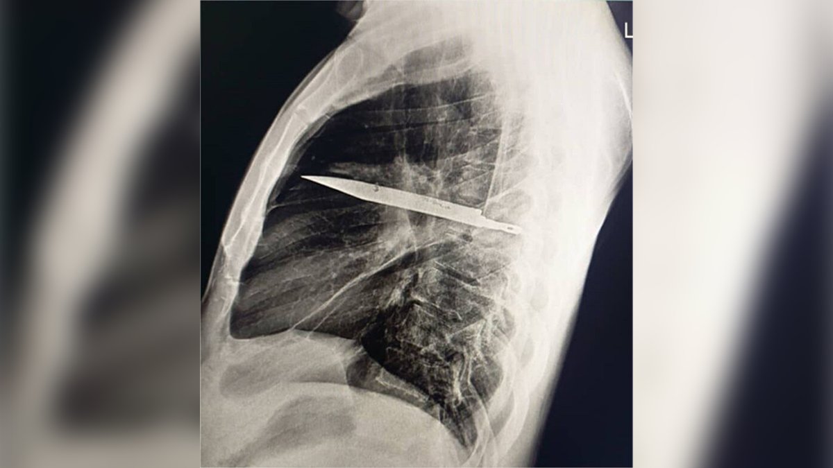 Doctors find knife embedded in man’s chest that was leaking pus – NBC 7 ...